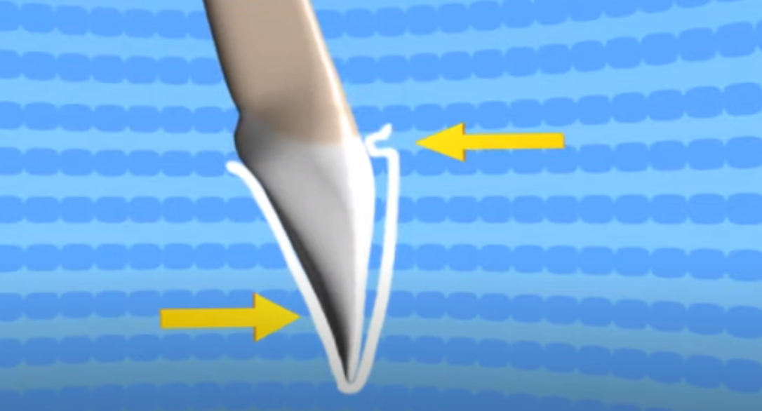 ¿Qué son los Power Ridges? INVISALIGN Ortodoncia Invisible